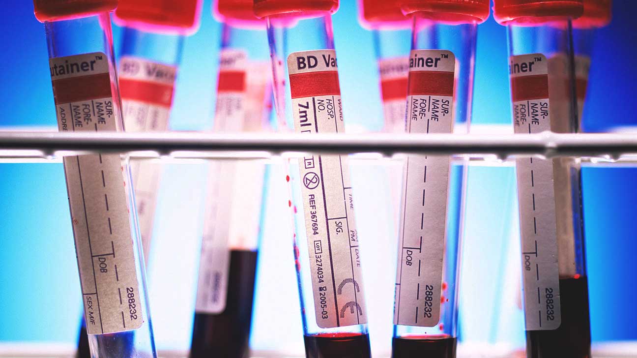 Multiple Sclerosis and Lipid Levels