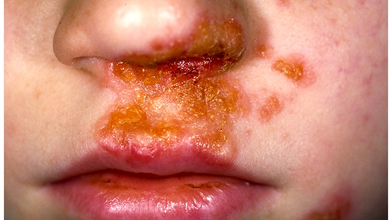Red Spots On Baby S Tongue And Lips Images Free - Infoupdate.org