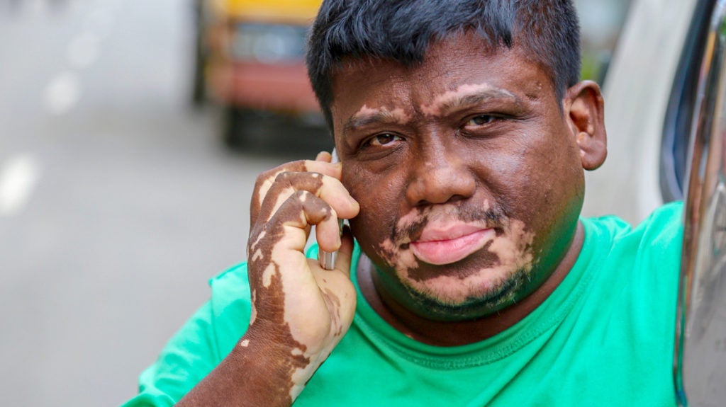 Depigmentation on the Face: Symptoms, Causes, and Treatments