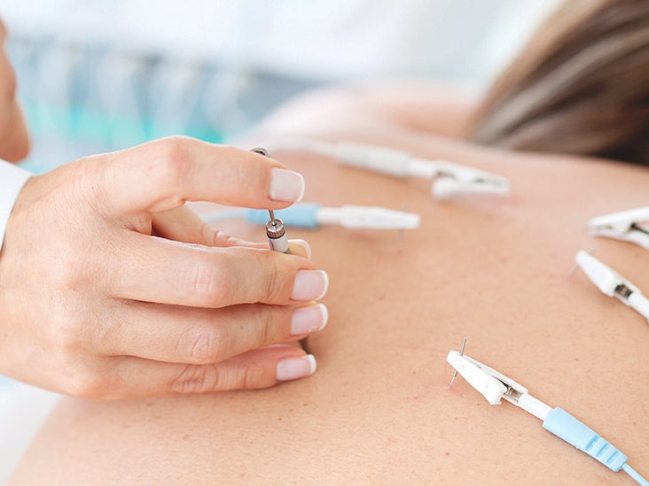 Electroacupuncture: Uses, Process, Evidence, Side Effects, and Safety