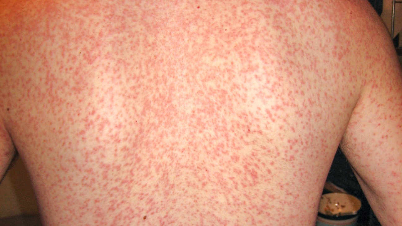 Mononucleosis Symptoms Causes