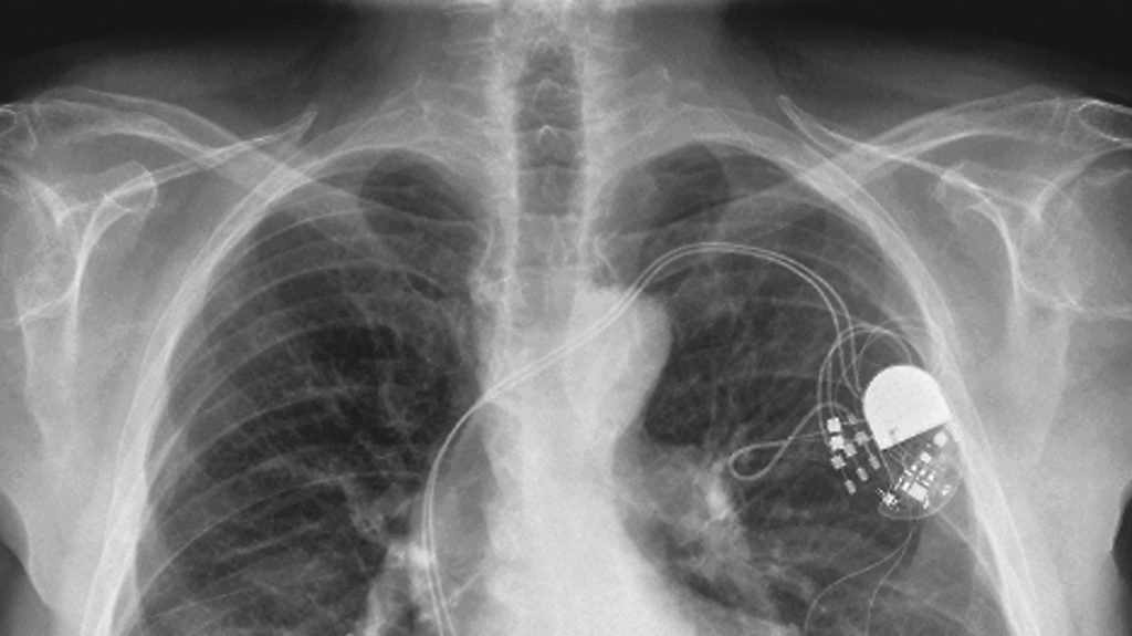 Ai Can Improve Xray Identification Of Pacemakers In