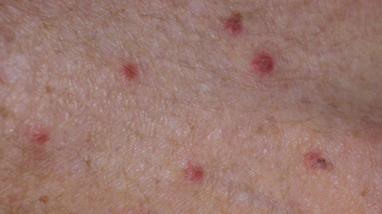 Carpet Allergy Symptoms Home Alqu Carpet Allergy Symptoms Home Alqu