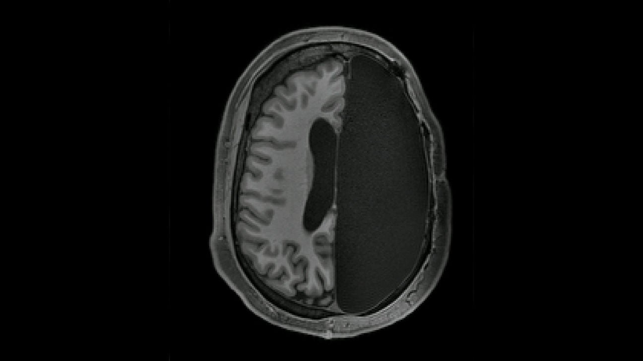 Here’s What Happens When You Remove Half Your Brain