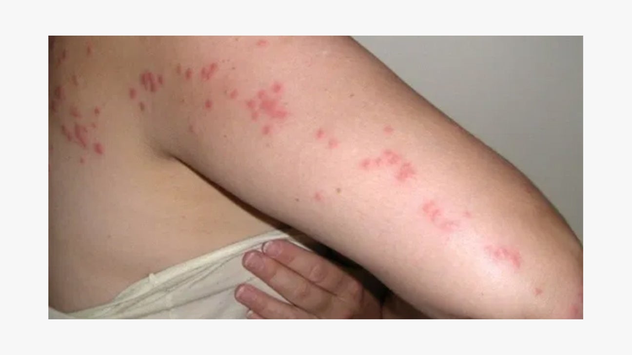 Bed Bug Bites Swollen Lips Lipstutorial
