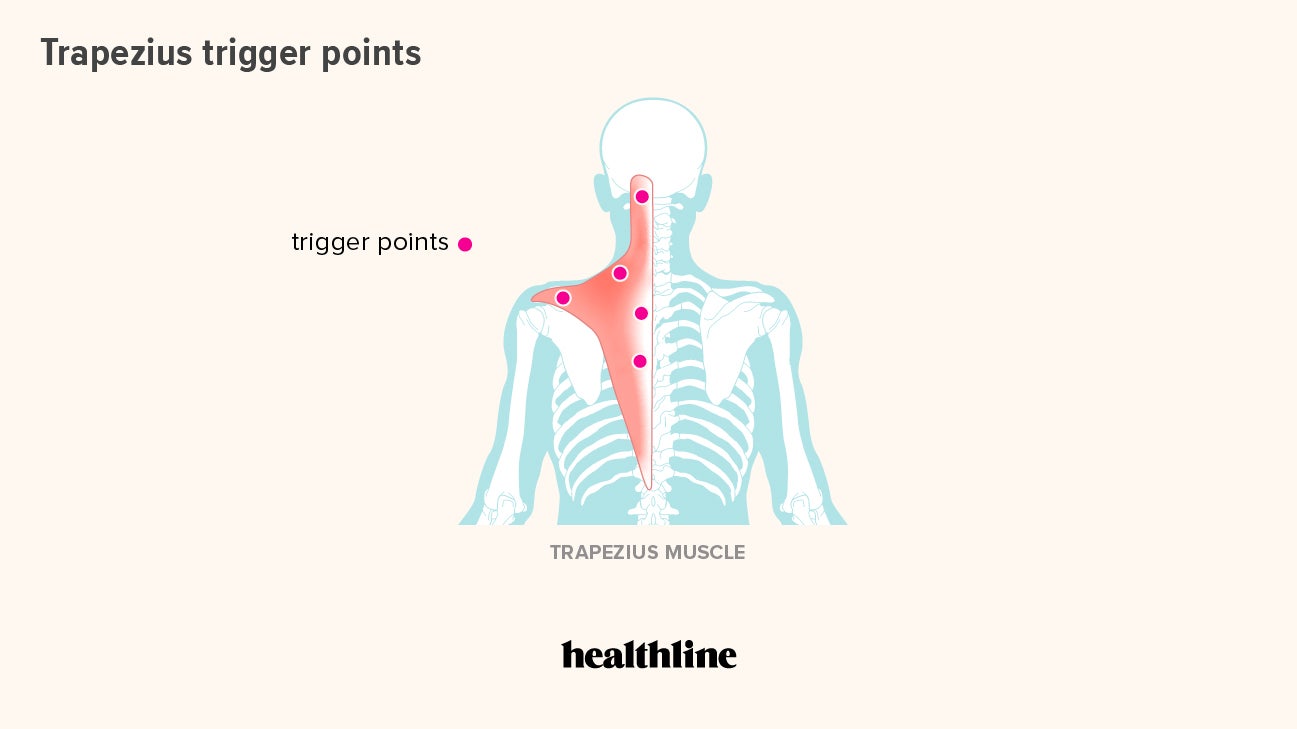 Trapezius Trigger Points: Causes, Treatment, and Prevention