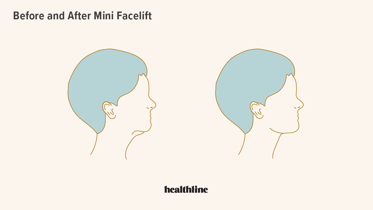 Mini Facelift: Procedure, Risks, Effectiveness, and More