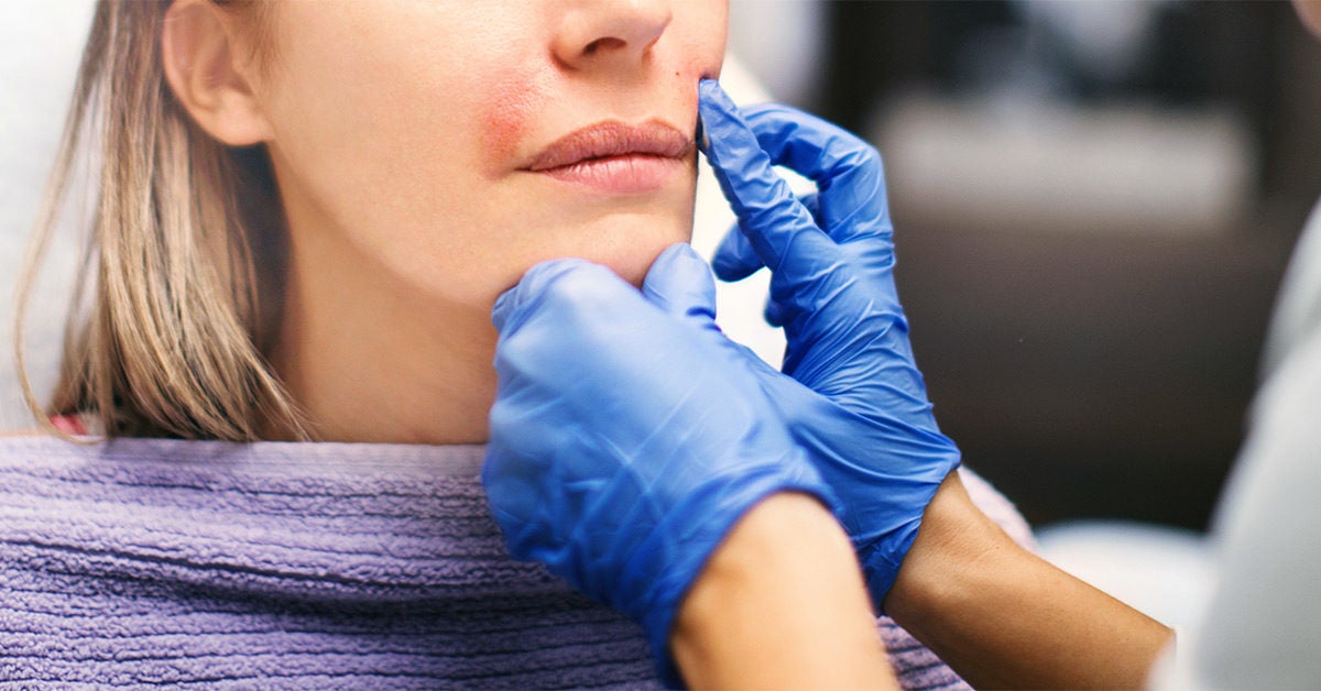 Nasolabial Fold Filler Procedure, Benefits, Risks, and Pictures Nasolabial Fold Filler Procedure, Benefits, Risks, and Pictures