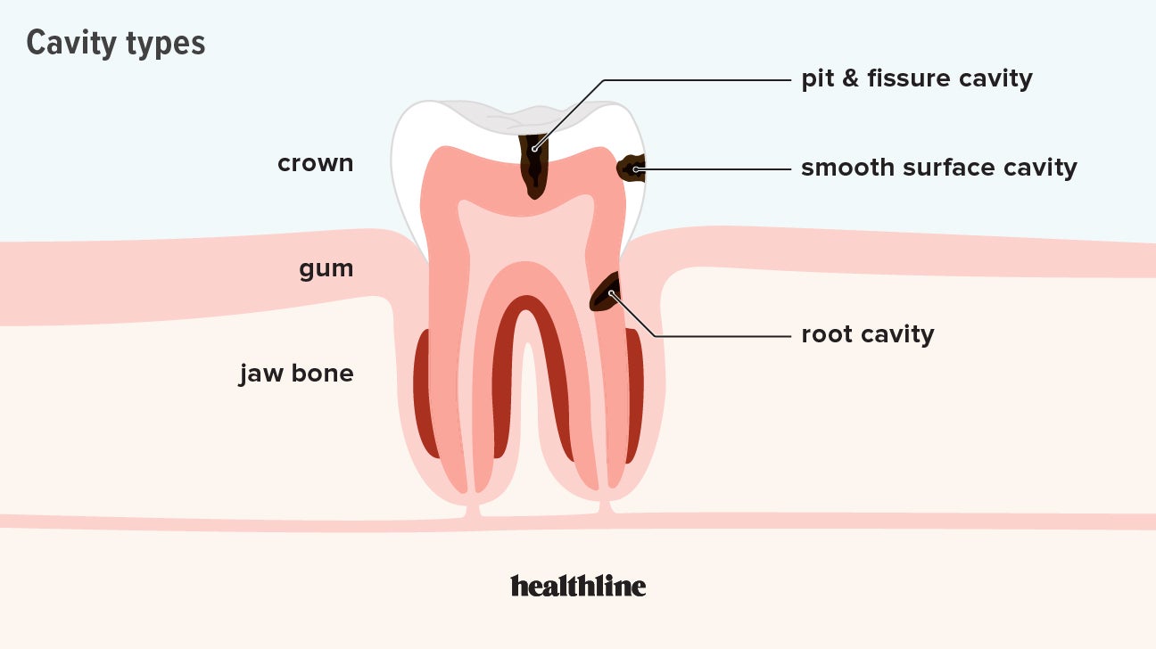 Root Cavity Causes Symptoms Diagnosis And Treatment Root Cavity Causes Symptoms Diagnosis And Treatment
