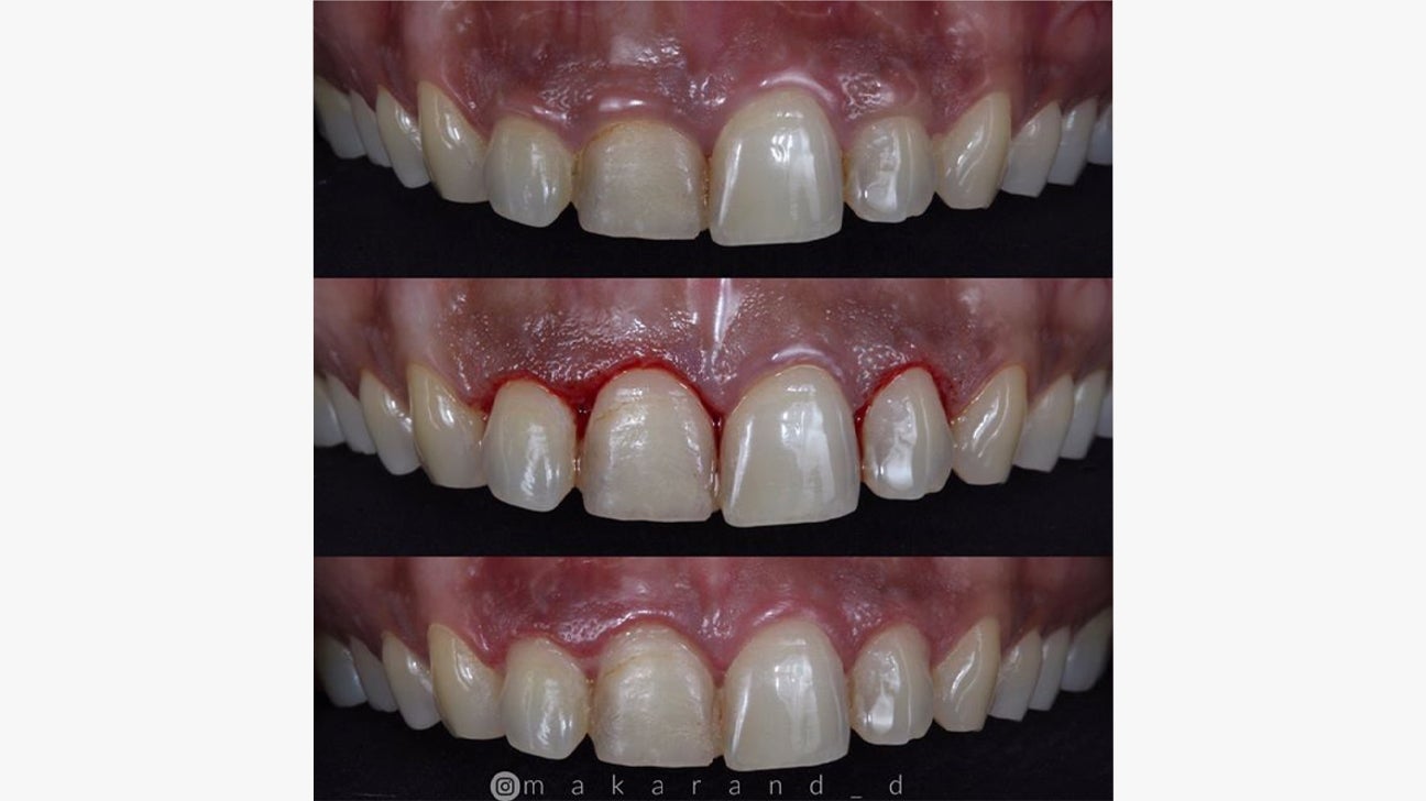 What Is A Gingivectomy Procedure Recovery 41 OFF What Is A Gingivectomy Procedure Recovery 41 OFF
