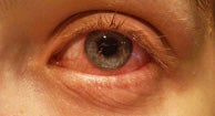 Allergic Conjunctivitis: Types, Causes, and Symptoms