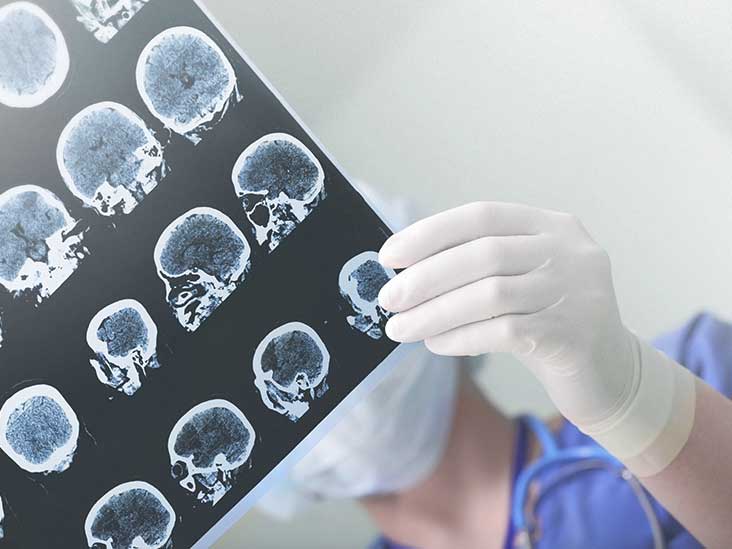 Craniectomy: Recovery, Complications, and Outlook