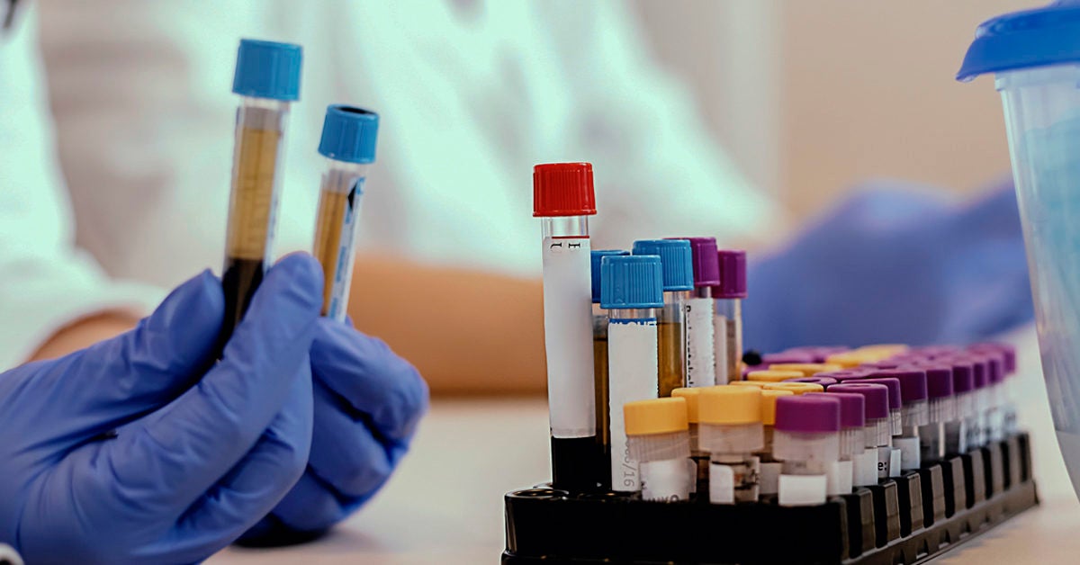 Child-Pugh Score for Chronic Liver Disease and Cirrhosis