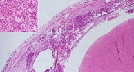 Pneumococcal Meningitis: Causes, Symptoms and Diagnosis