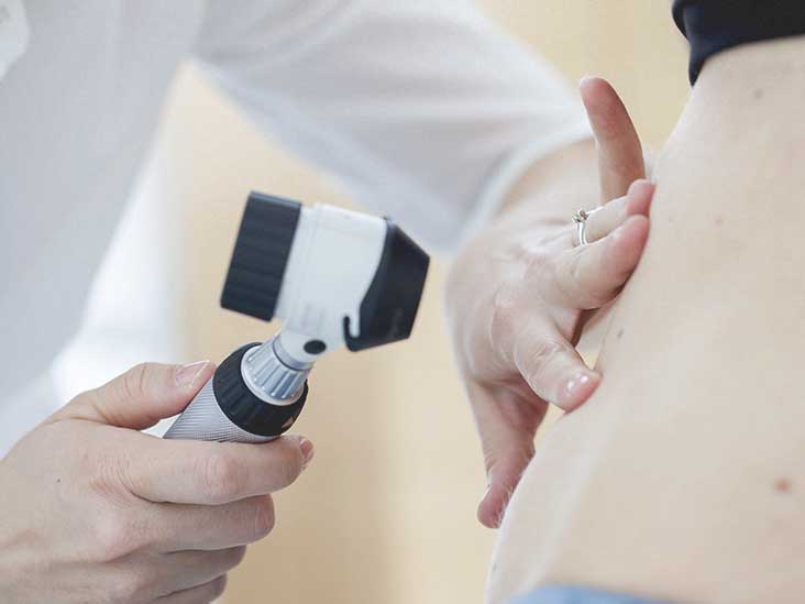 Calciphylaxis: Pictures, Definition, Symptoms, Treatment, & Outlook