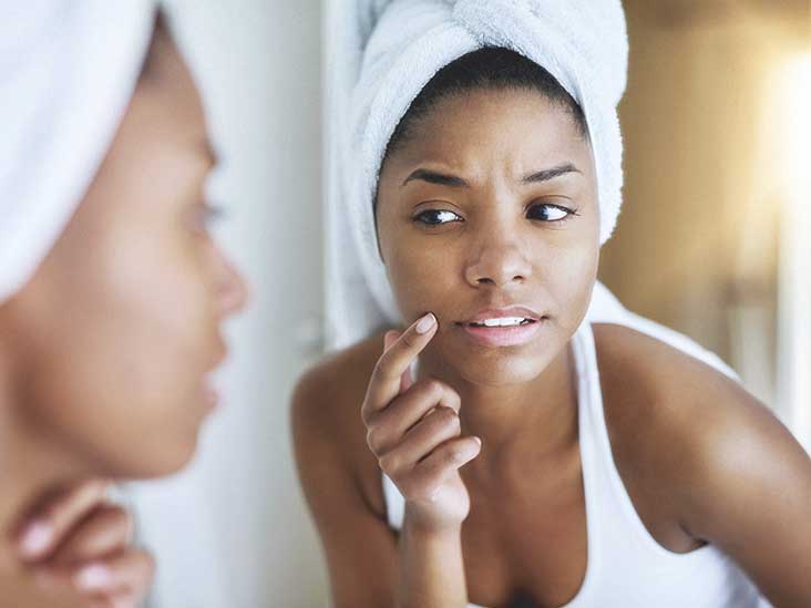 9 Fever Blister Remedies Causes And More 9-fever-blister-remedies-causes-and-more