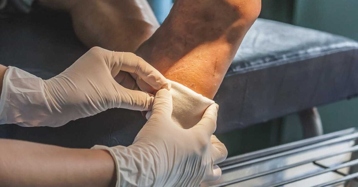 New Bandage May Help Wounds Heal More Quickly for People with Dia