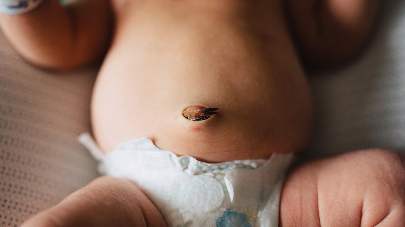 The Umbilical Cord Fell Off What Should I Do 