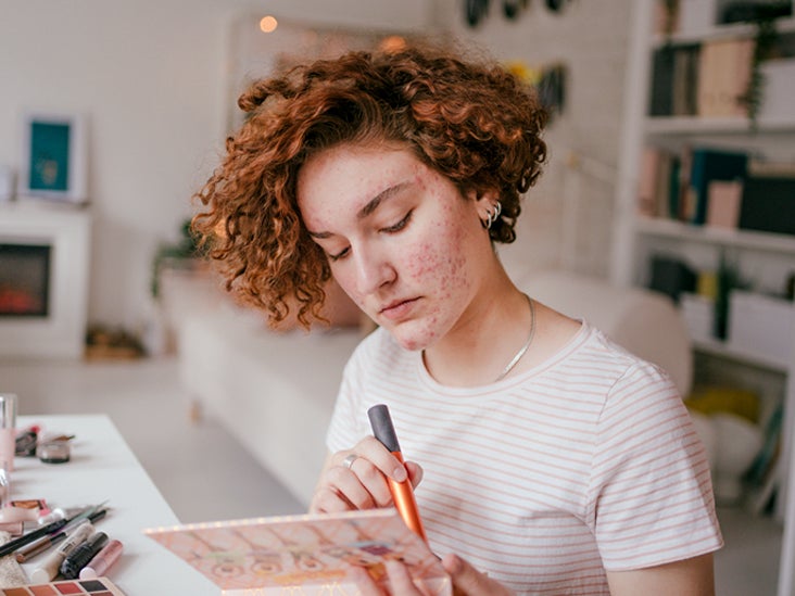 Why Am I Breaking Out? Reasons, Explanations, Solutions for Breakouts