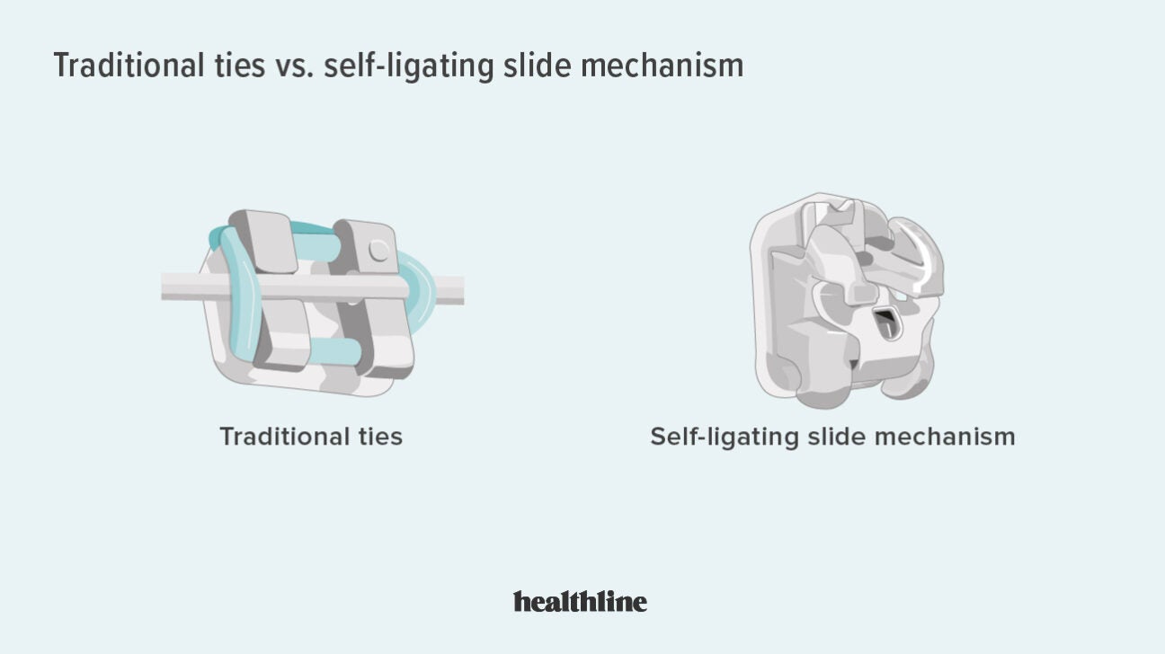 Self-Ligating Braces: How They Differ, Benefits, Cost