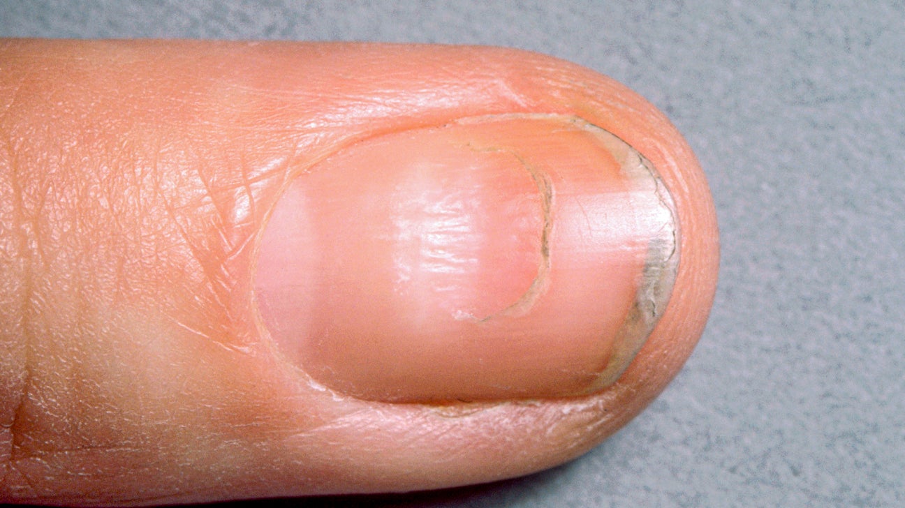 What Does It Mean When Your Fingernails Have Ridges Tutorial Pics