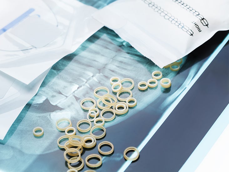 Invisalign Rubber Bands: Who Needs Them and What They Do