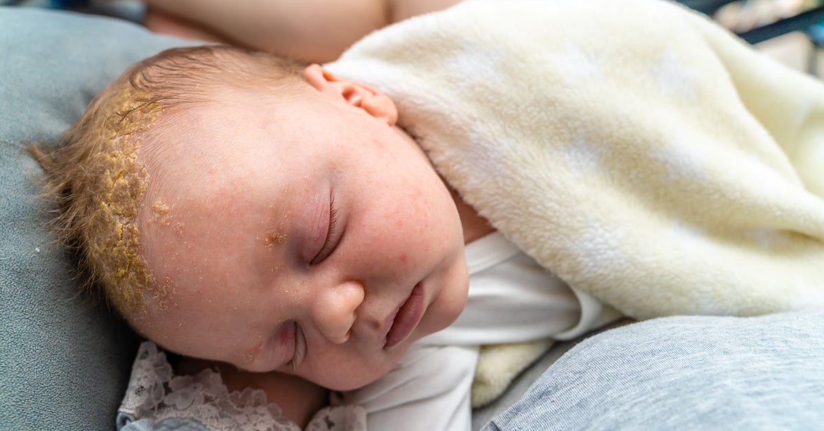 Cradle Cap On Eyebrows And Forehead Causes And Treatment