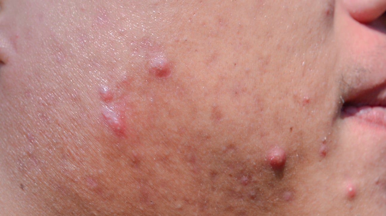 Cyst Pictures Causes Types Treatments And Prevention Cyst Pictures Causes Types Treatments And Prevention
