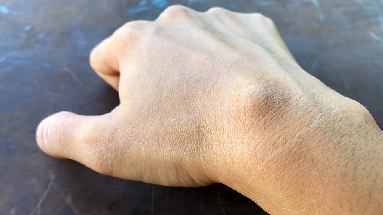 Cyst: Pictures, Causes, Types, Treatments, and Prevention