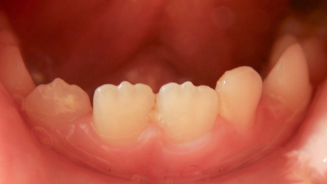 Jagged Teeth: Causes, Treatments, and More