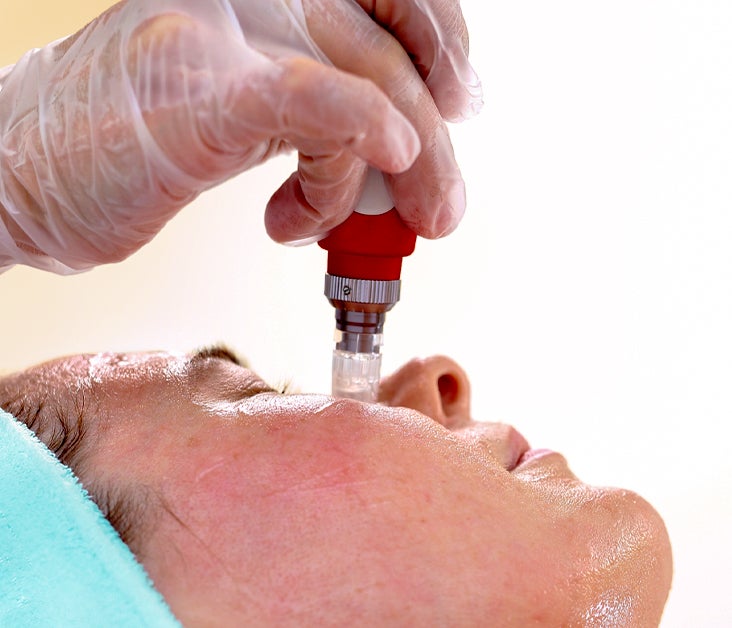 Microneedling Under the Eyes: Procedure, Cost, and More