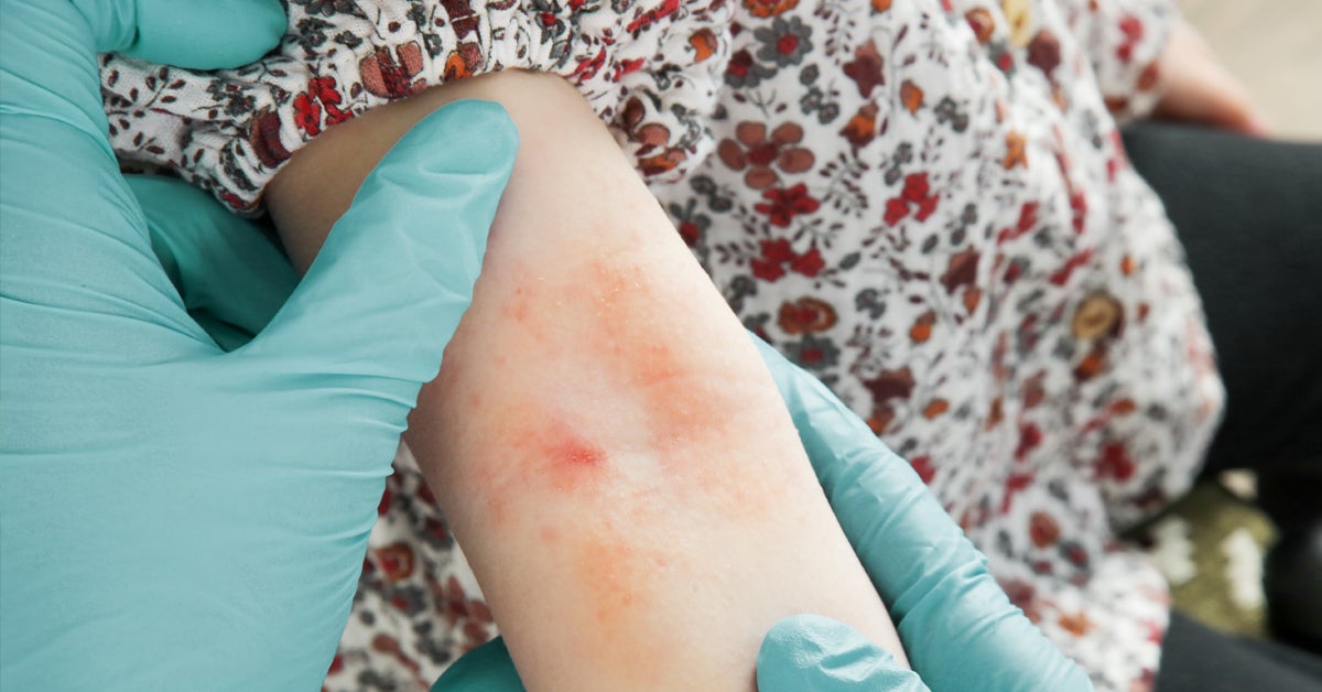 Psoriasis In Children Your FAQs