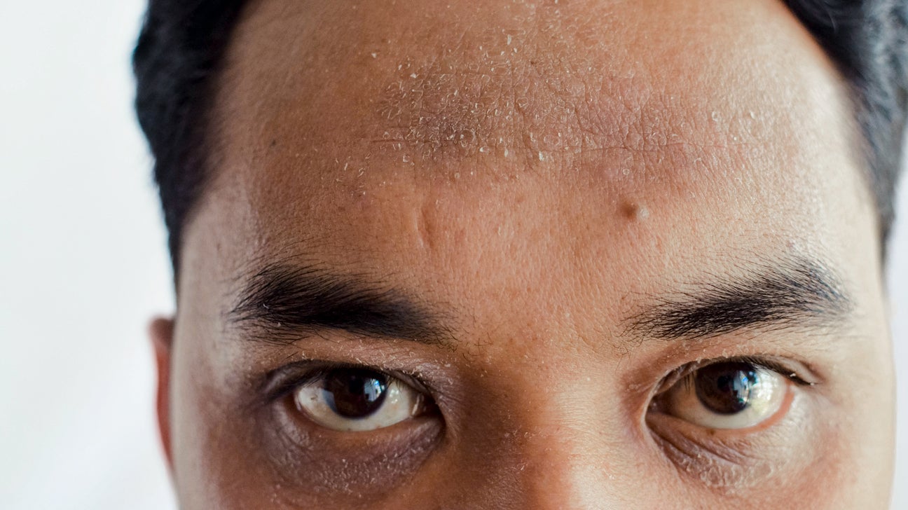 Dermatitis Face Dermatitis Face