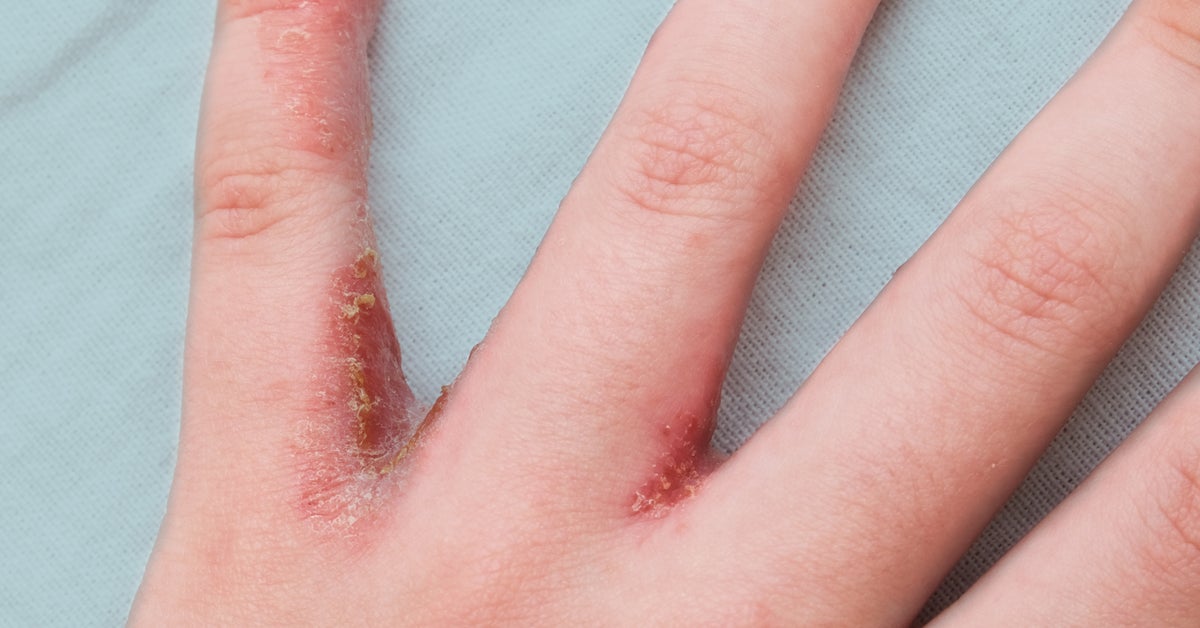 A Parent's Guide to Managing Psoriasis in Every Season