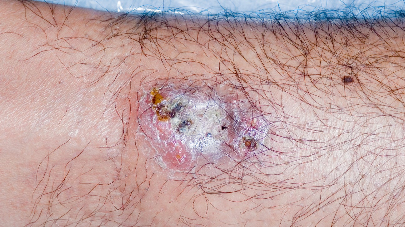 Crohn's Disease and Skin Issues: Rashes and More