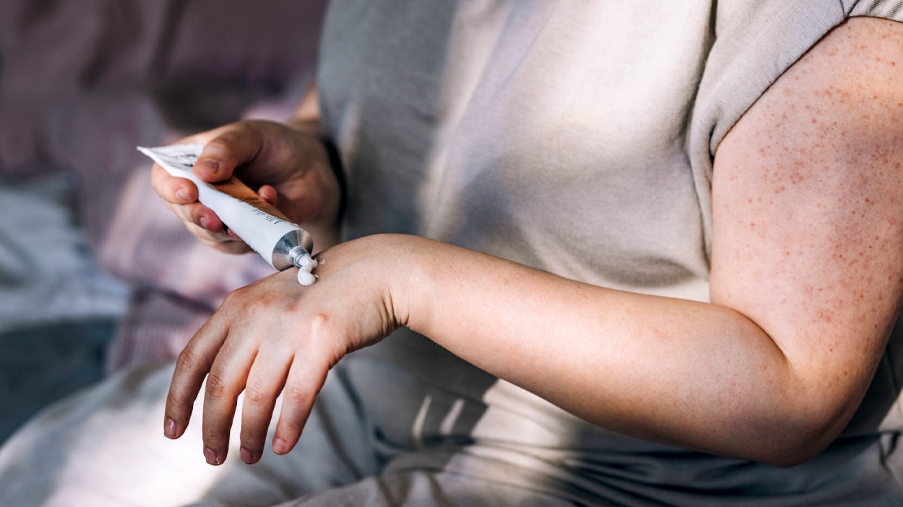 Understanding Topical Steroid Withdrawal (TSW) and Eczema