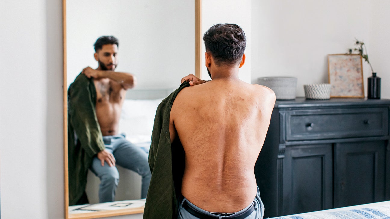 Is Eczema Genetic? What the Research Says About Causes and Triggers