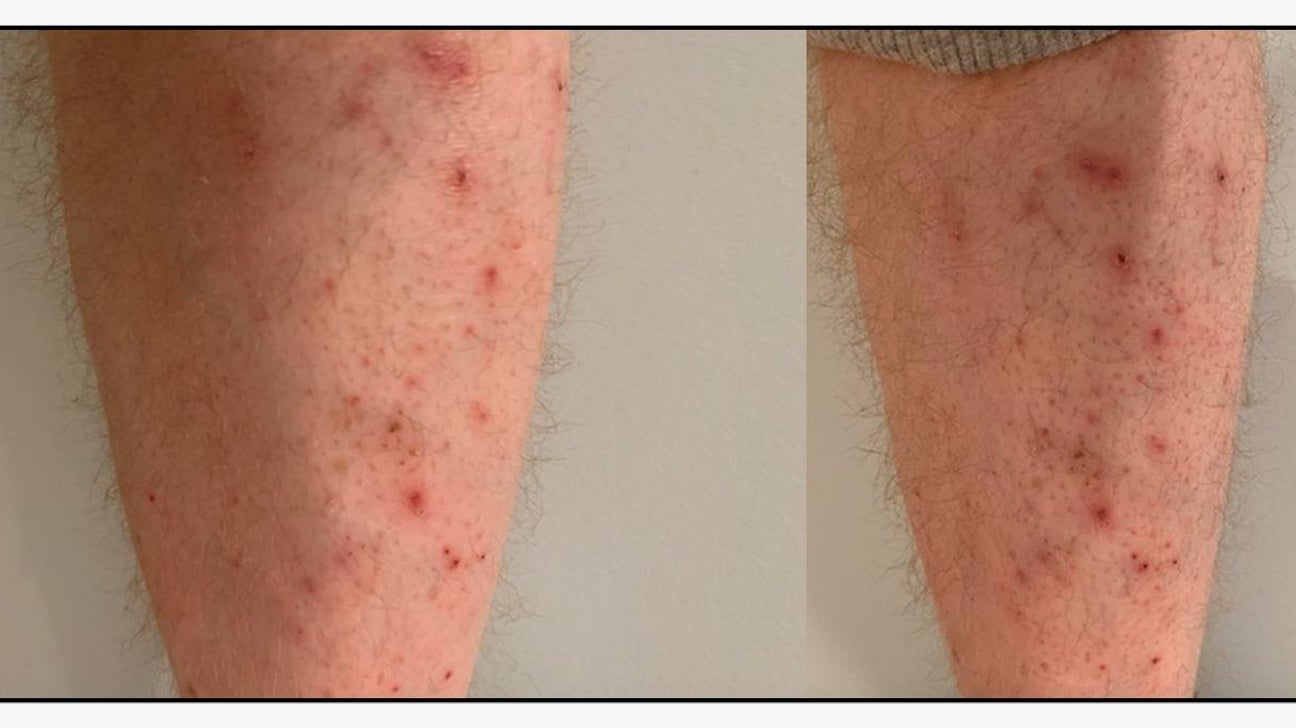 Scaly Skin Patches On Legs