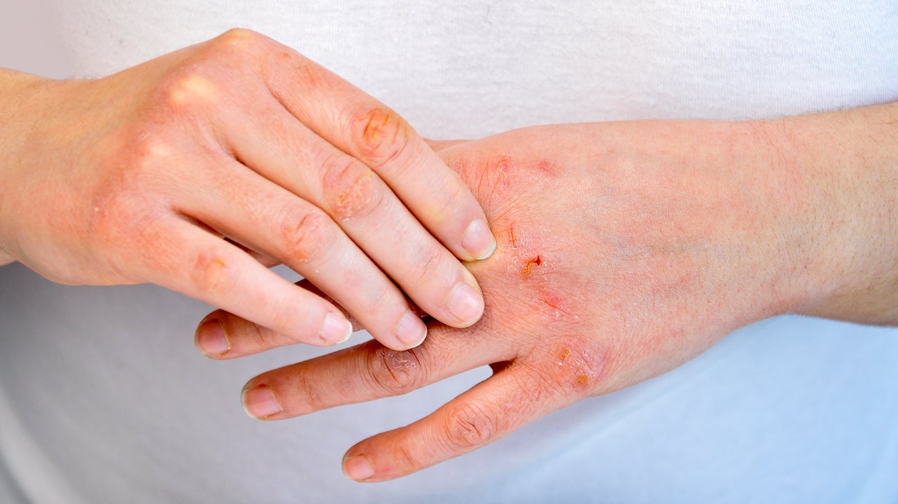 Dry Skin Patches: Causes, Symptoms, and More