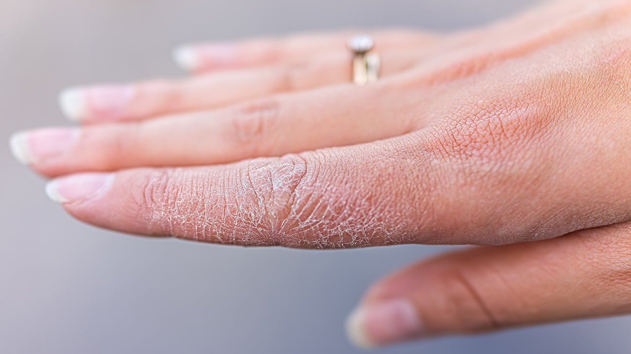 Dry Skin Patches: Causes, Symptoms, and More