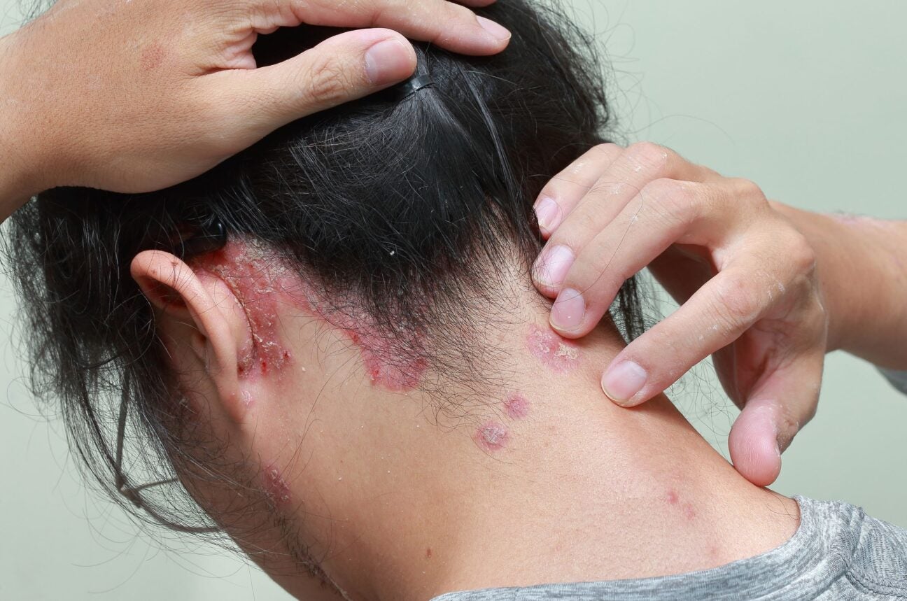 Scalp Psoriasis: Pictures, Treatment, and More