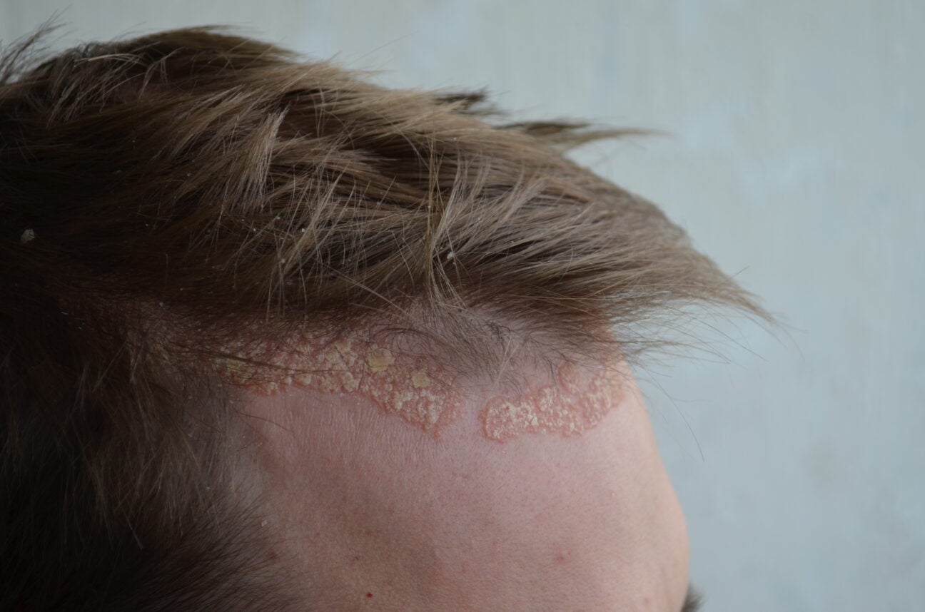 Scalp Psoriasis: Pictures, Treatment, and More
