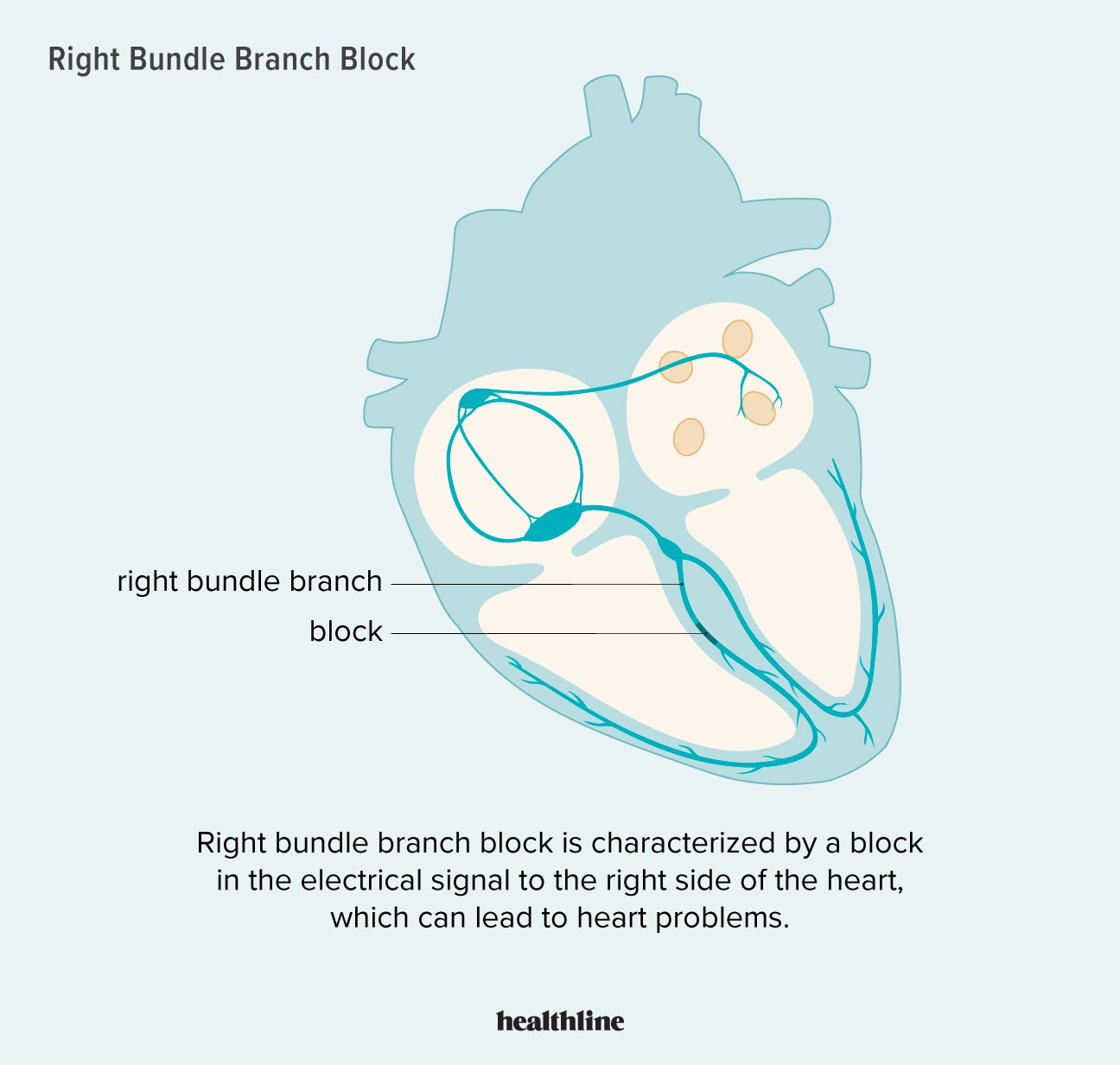 Right Bundle Branch Block: Symptoms, Causes, Diagnosis, Treatment
