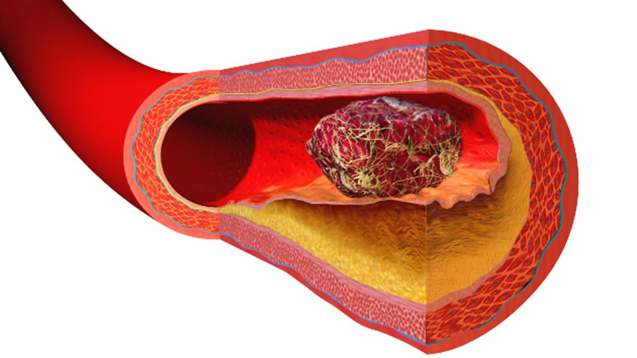 What Do Hemorrhoids Look Like: Types and More