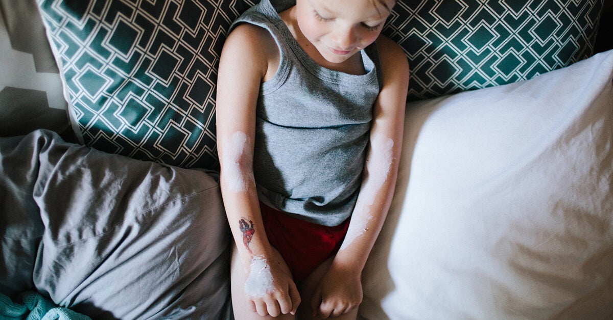 Flexural Eczema: Symptoms, Causes, Treatment and More