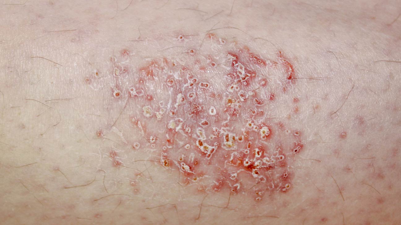 Vesicles Skin Vesicles Skin