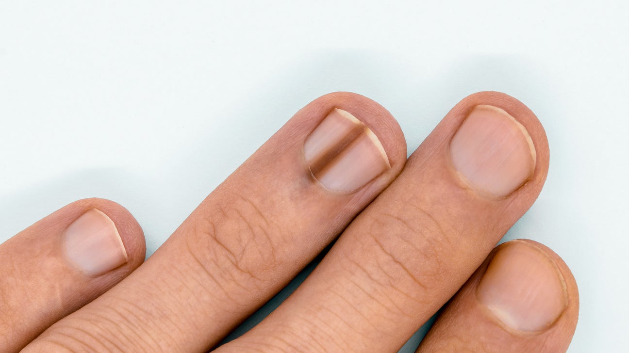 Melanonychia: What It Is, Causes, and More