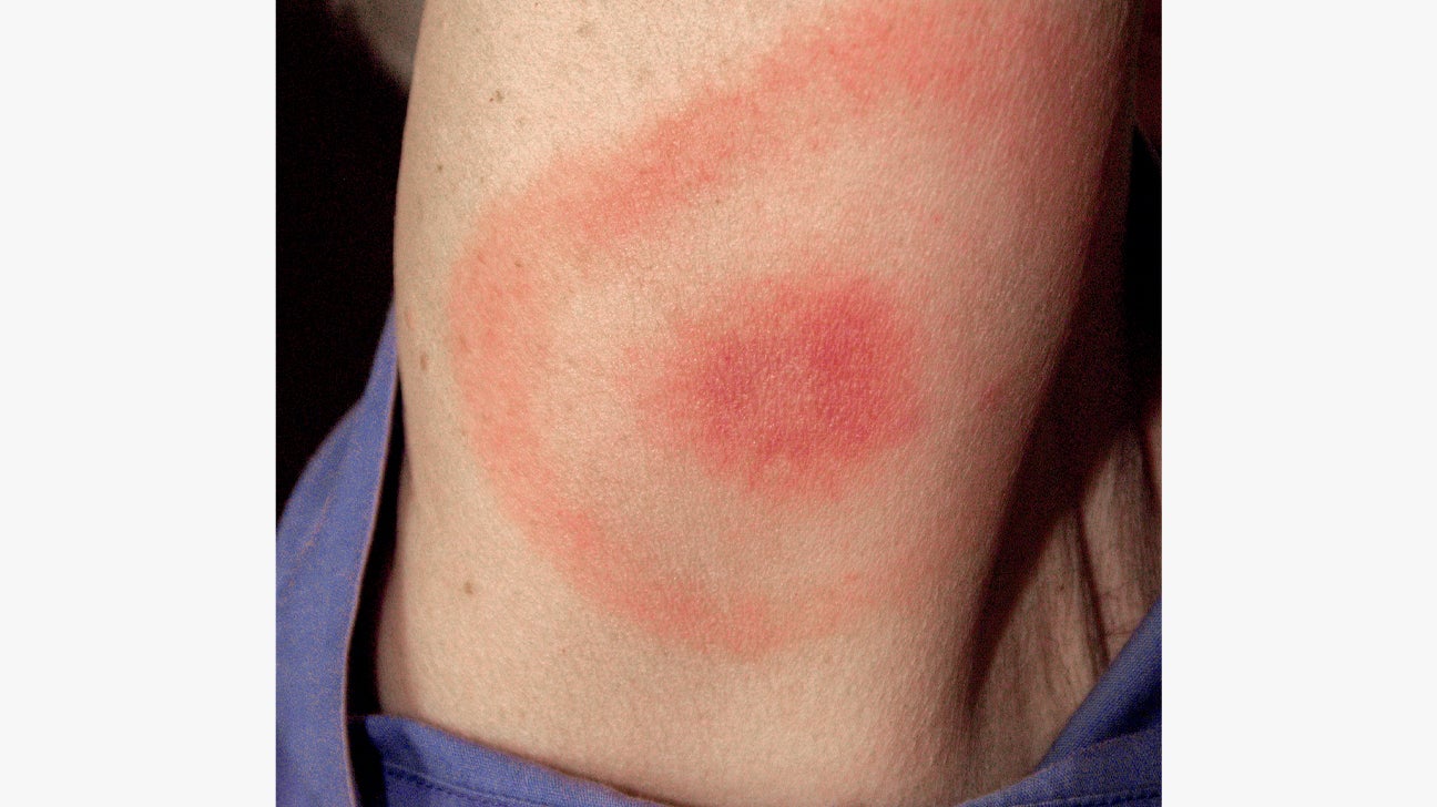 Allergic Reaction To Tick Bites Allergic Reaction To Tick Bites