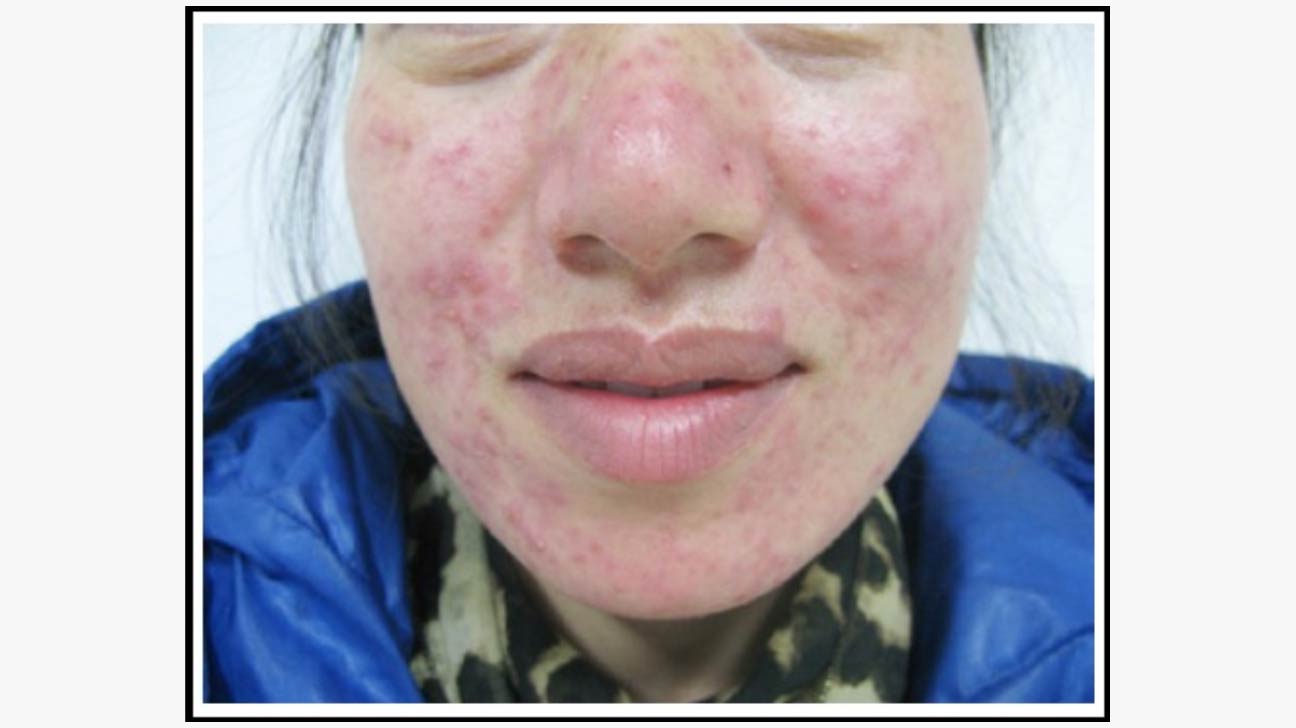 Severe Rosacea