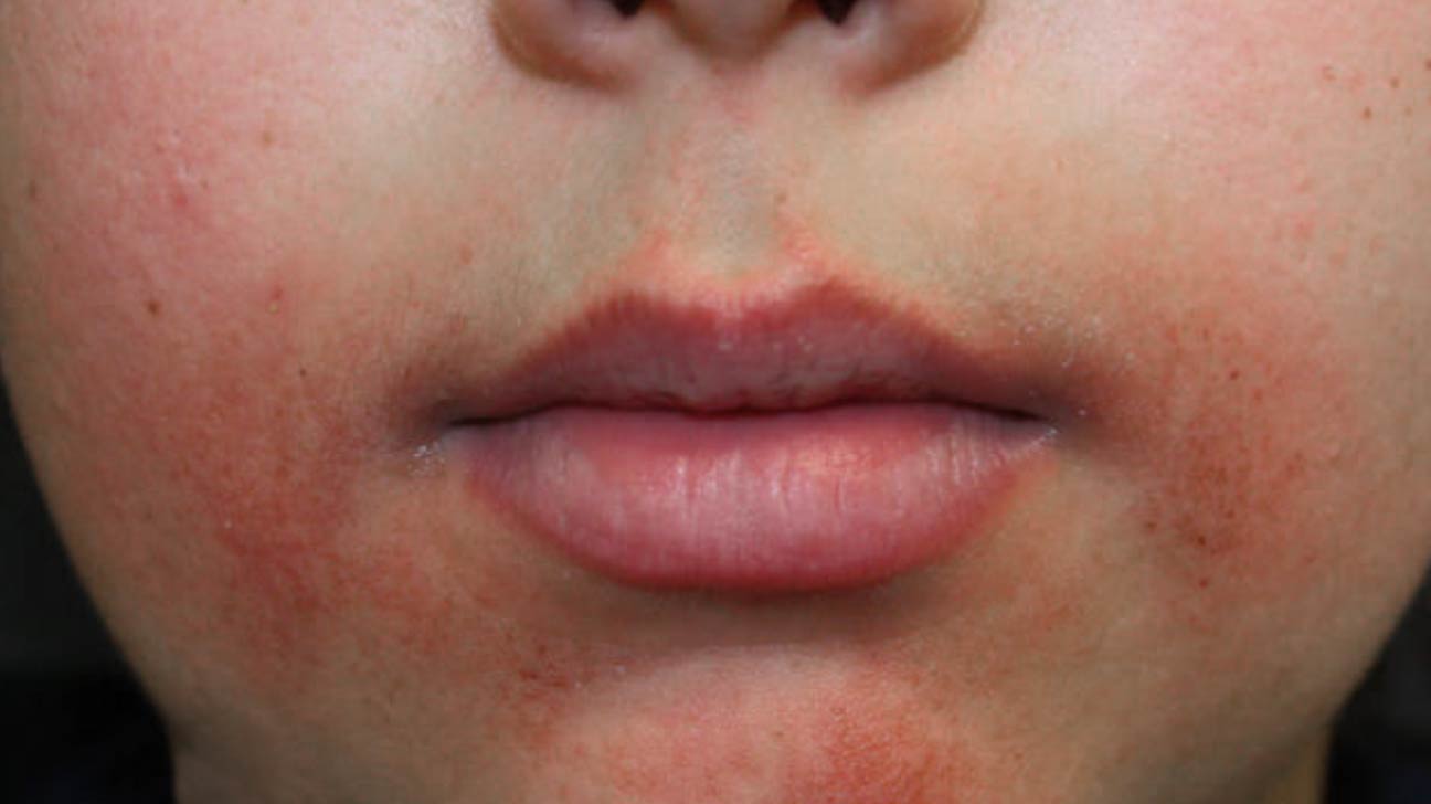 Perioral Dermatitis Treatment How To Cure Causes And More